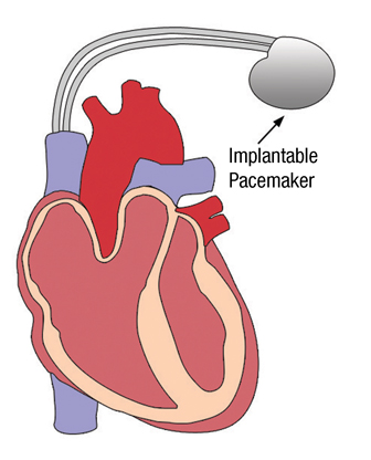 Micromachined Reed Switches Offer New Solutions to Many MEMS ...